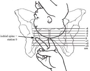 Mechanism of Normal Delivery - Hyderabad's Best Gynaecology Clinics